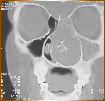 A case of rhinolithiasis - دکتر علیرضا محبی